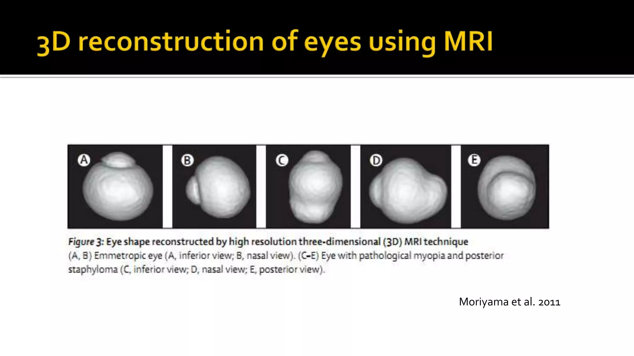 The burden of Myopia | PPTX