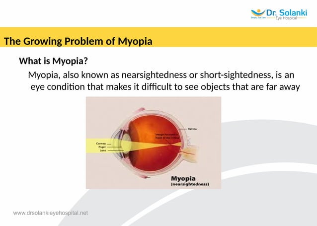 Myopia prevalence | PPTX
