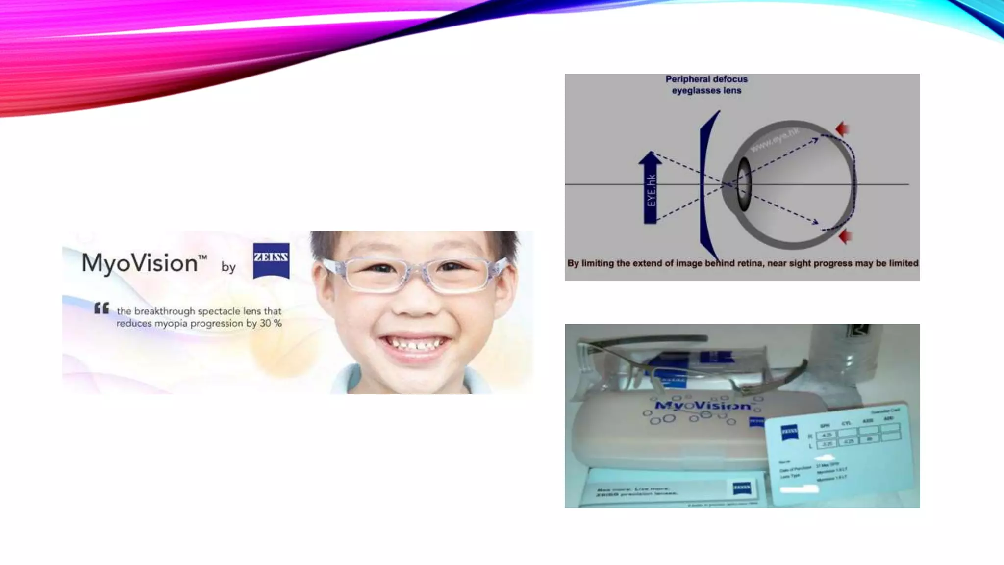 Myopia progression | PPTX