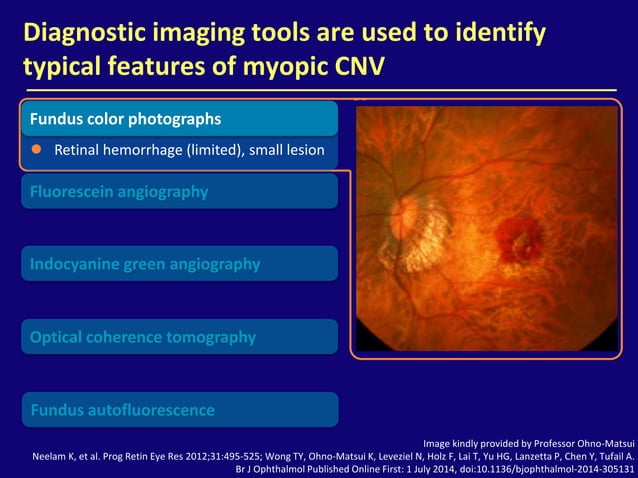 Myopic CNVM -DIAGNOSIS AND MGT BY dr ajay dudani