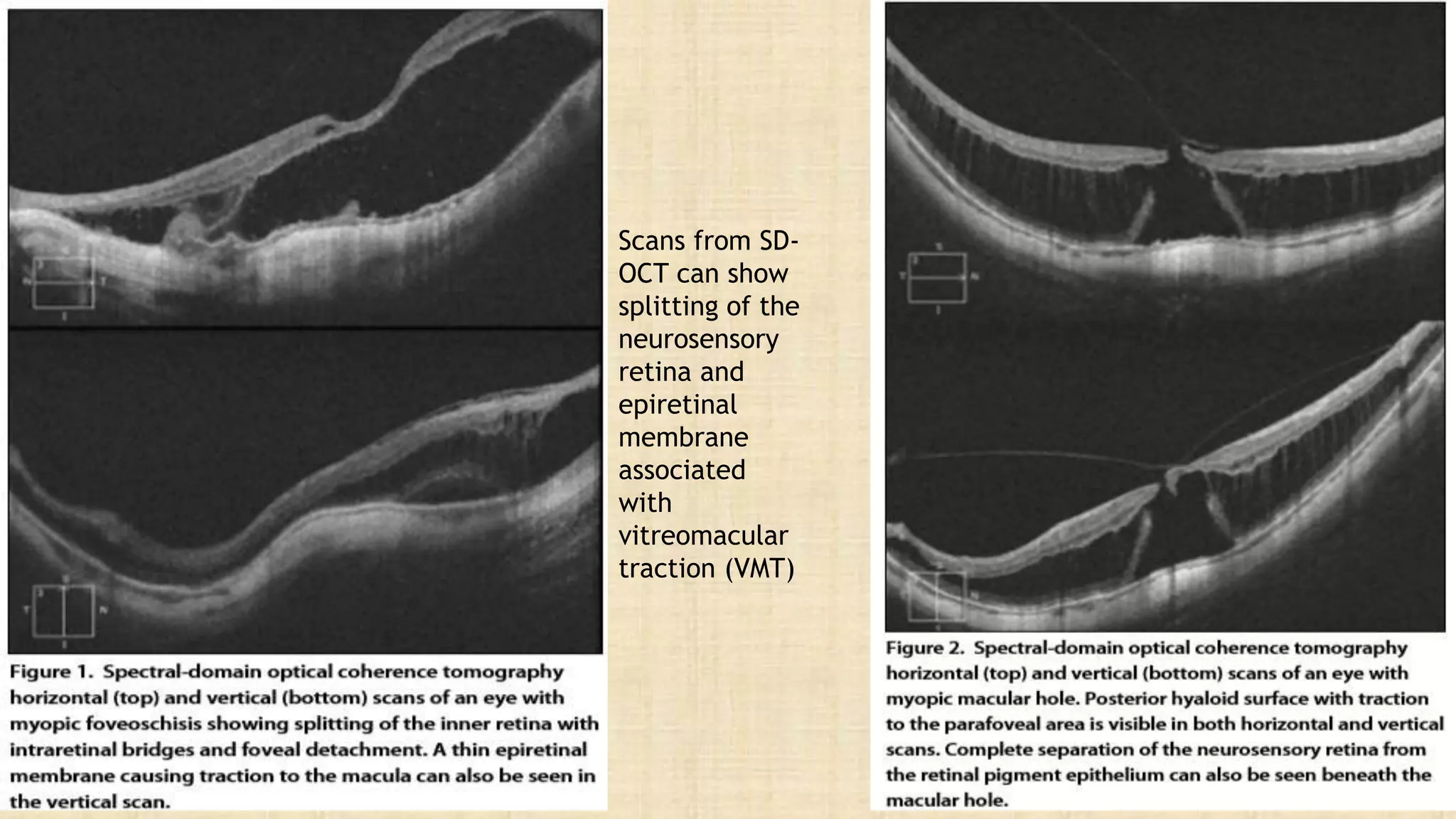 Myopic maculopathy in Pathological Myopia | PPTX