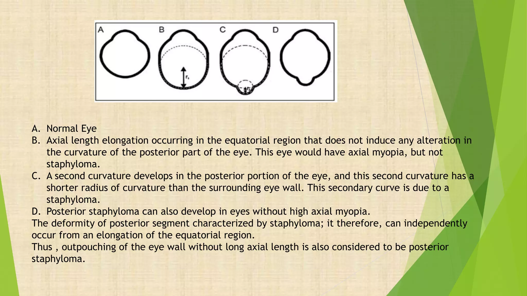 Myopic maculopathy in Pathological Myopia | PPTX