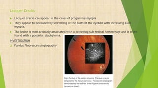 Myopic maculopathy in Pathological Myopia | PPTX
