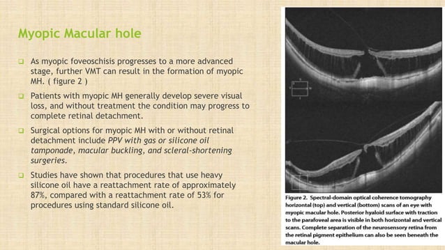 Myopic maculopathy in Pathological Myopia | PPTX