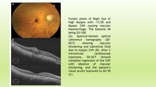 Myopic maculopathy in Pathological Myopia | PPTX