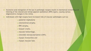 Myopic maculopathy in Pathological Myopia | PPTX