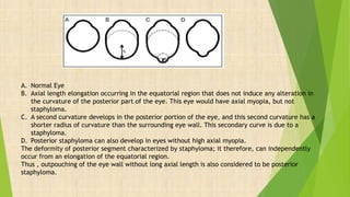 Myopic maculopathy in Pathological Myopia | PPTX