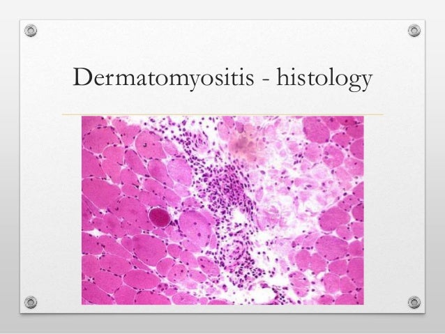 Dermatomyositis Histology