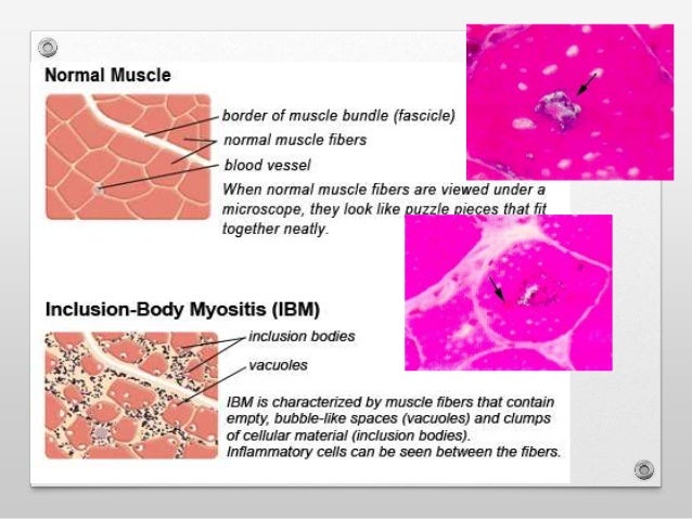 Myositis