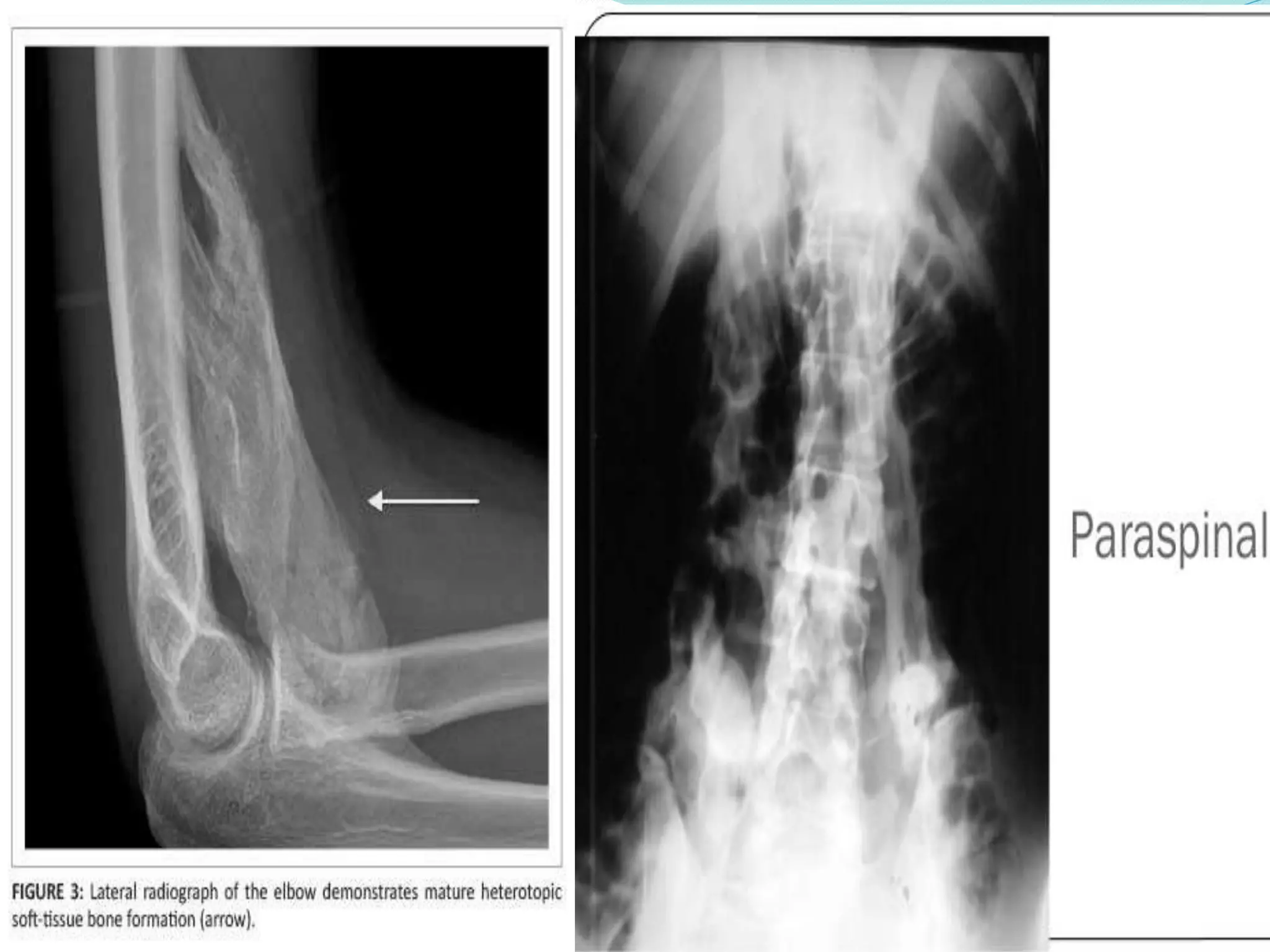 Myositis ossificans | PPTX