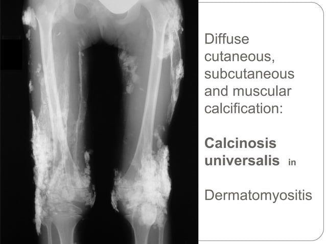 Myositis ossificans