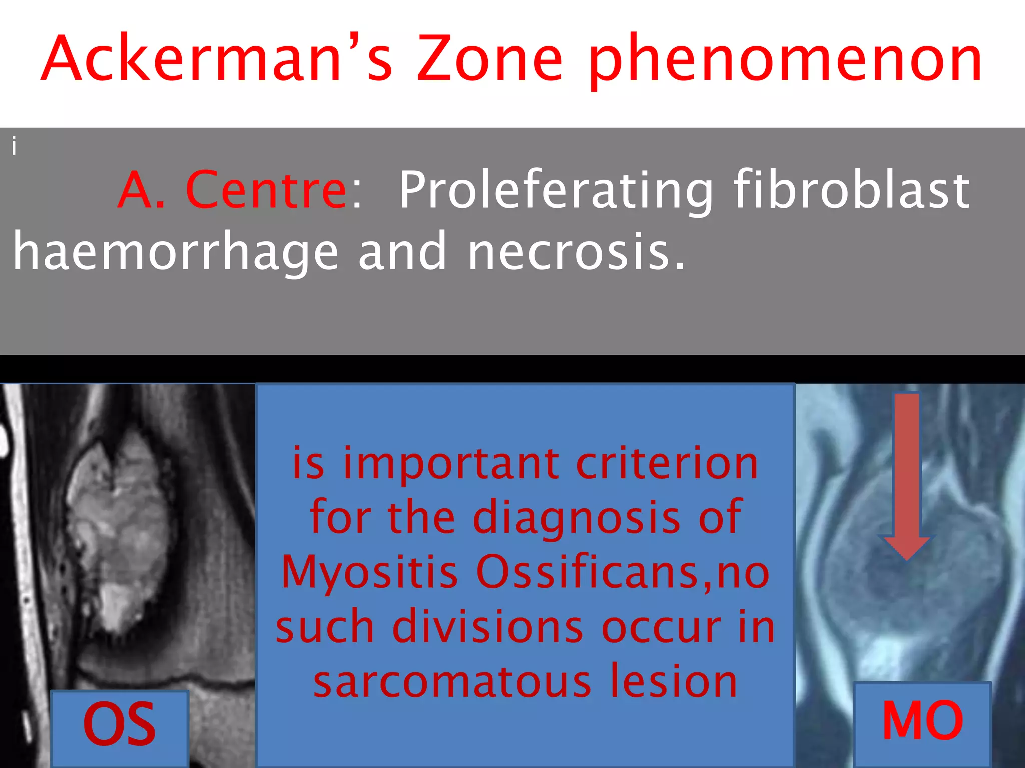 Myositis ossificans traumatica: A benign lesion with a malignant ...