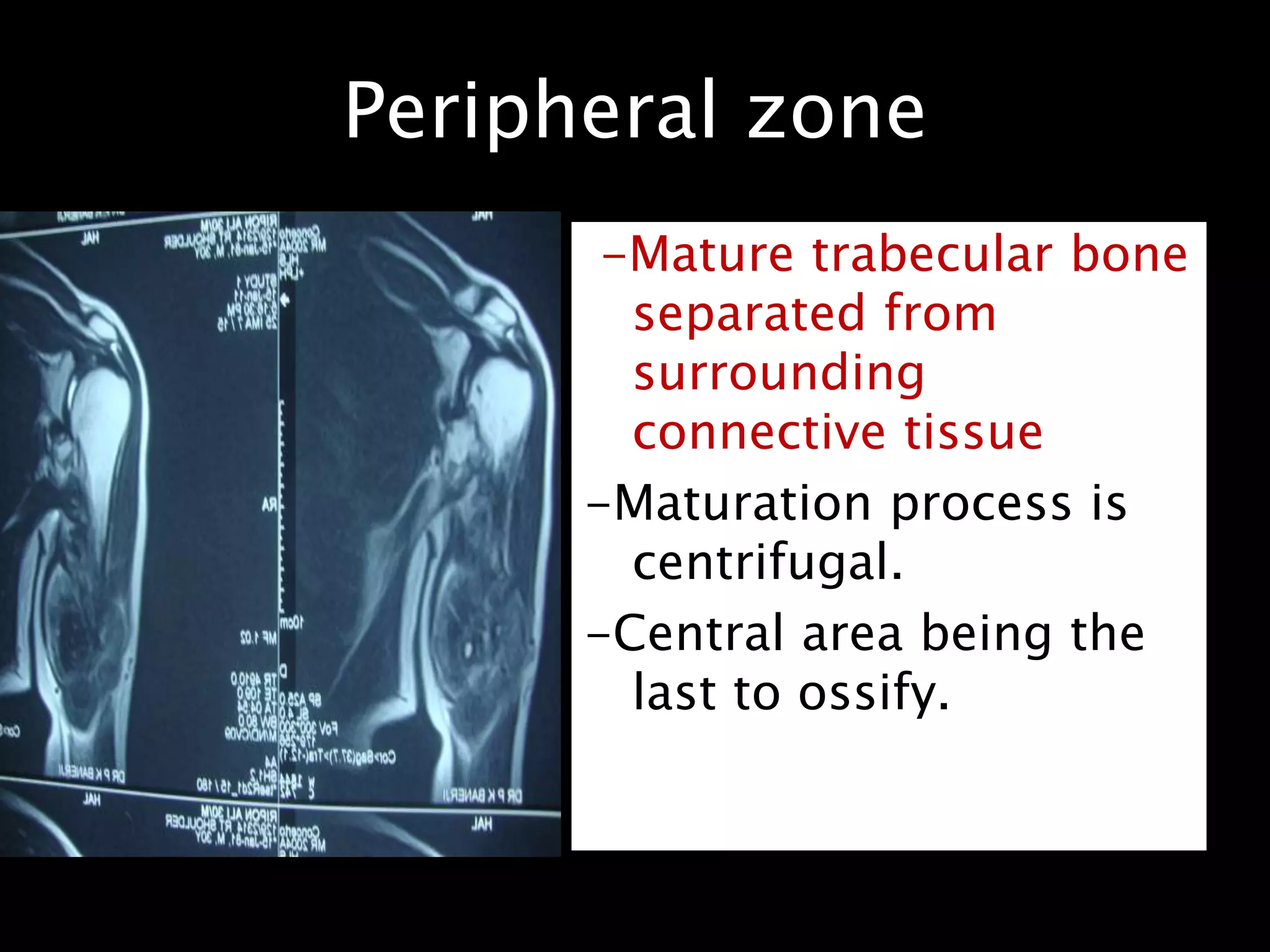 Myositis ossificans traumatica: A benign lesion with a malignant ...