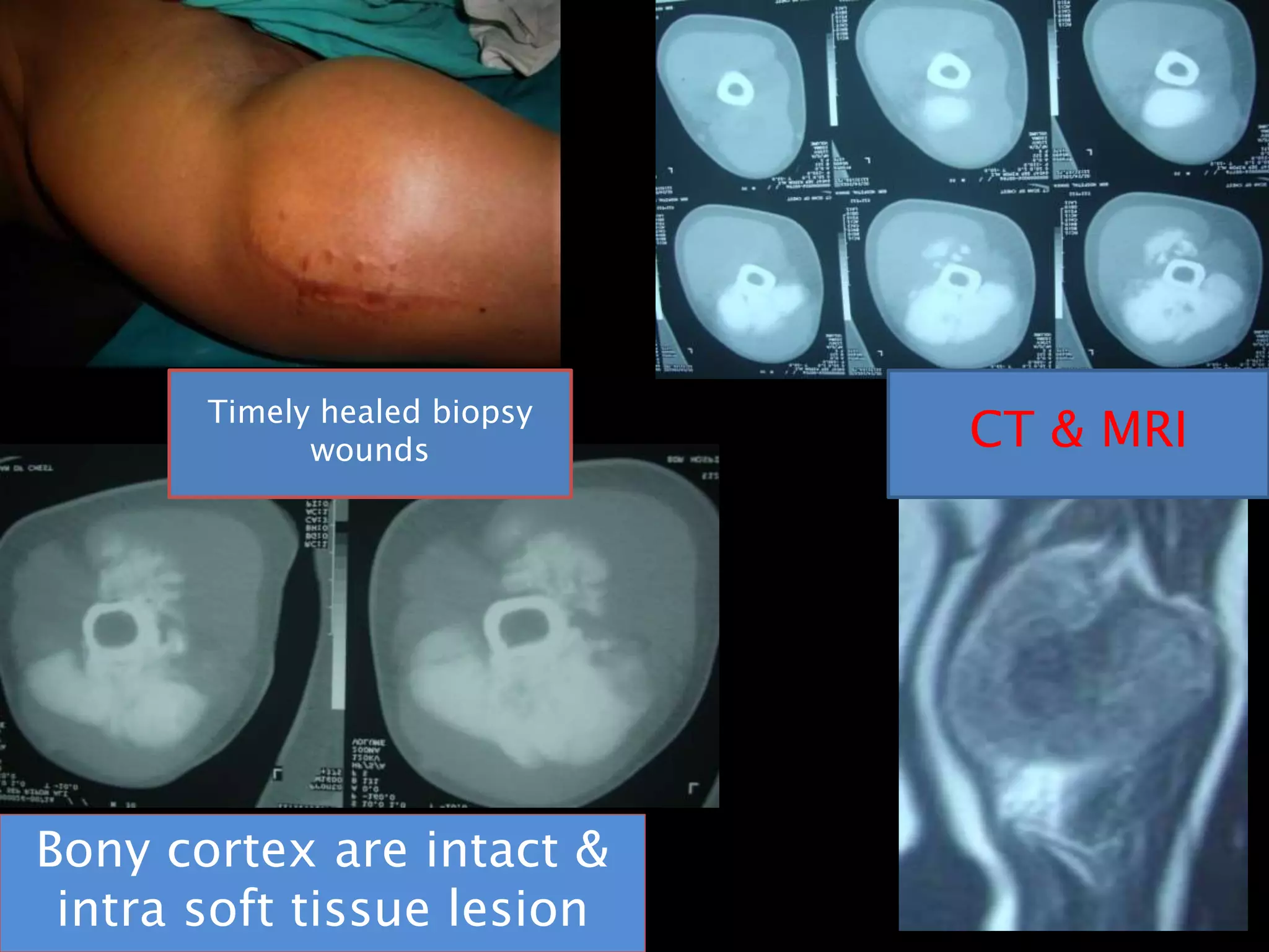 Myositis ossificans traumatica: A benign lesion with a malignant ...