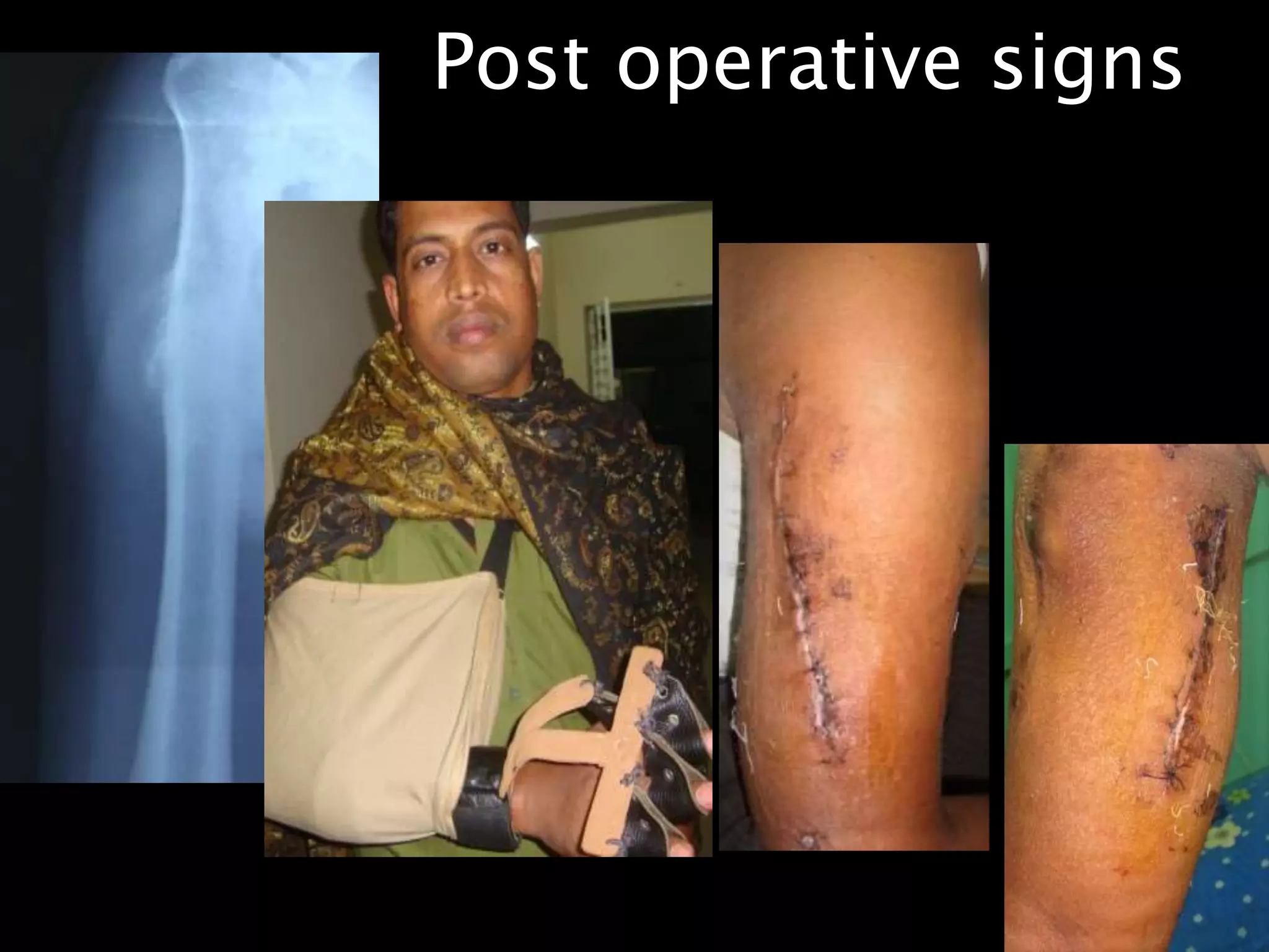 Myositis ossificans traumatica: A benign lesion with a malignant ...