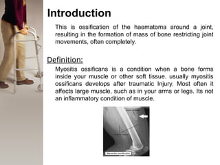 MYOSITIS OSSIFICANS ( POST TRAUMATICA OSSIFICATION ).pptx