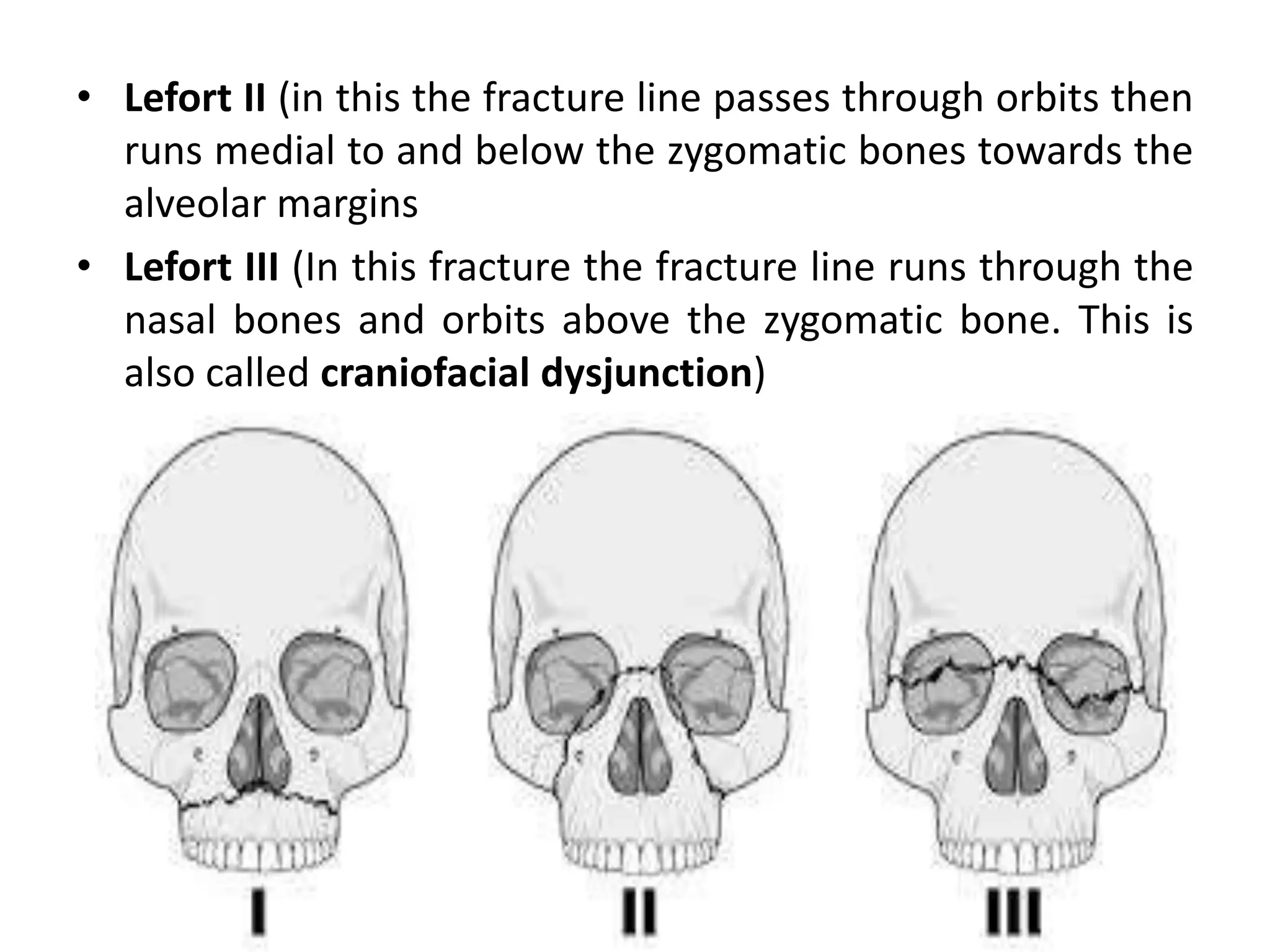 Osteology of facial skeleton | PPTX