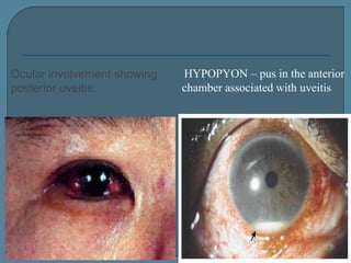 behcets disease | PPTX
