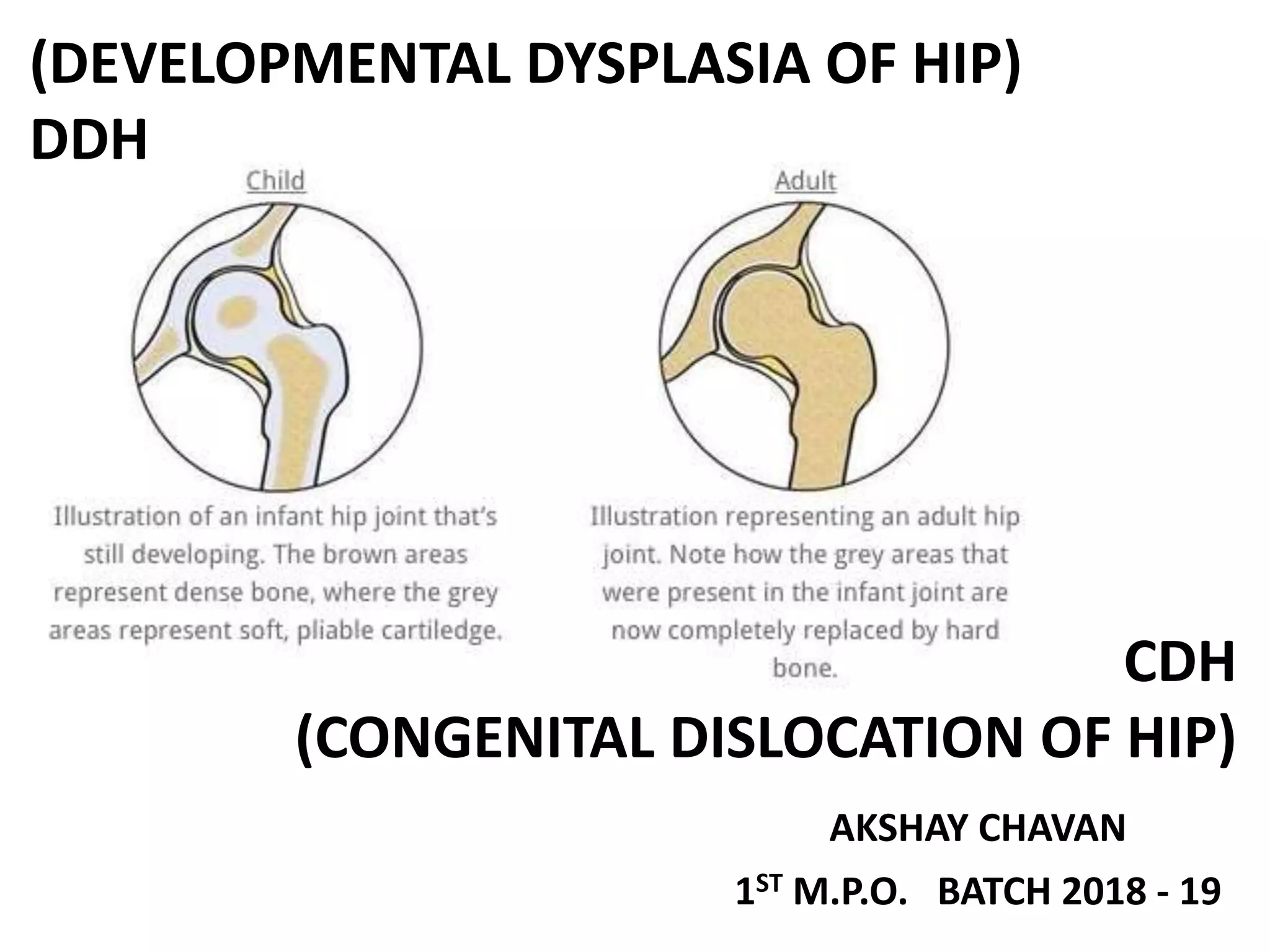 CDH AND DDH | PPTX | Pregnancy | Reproductive Health
