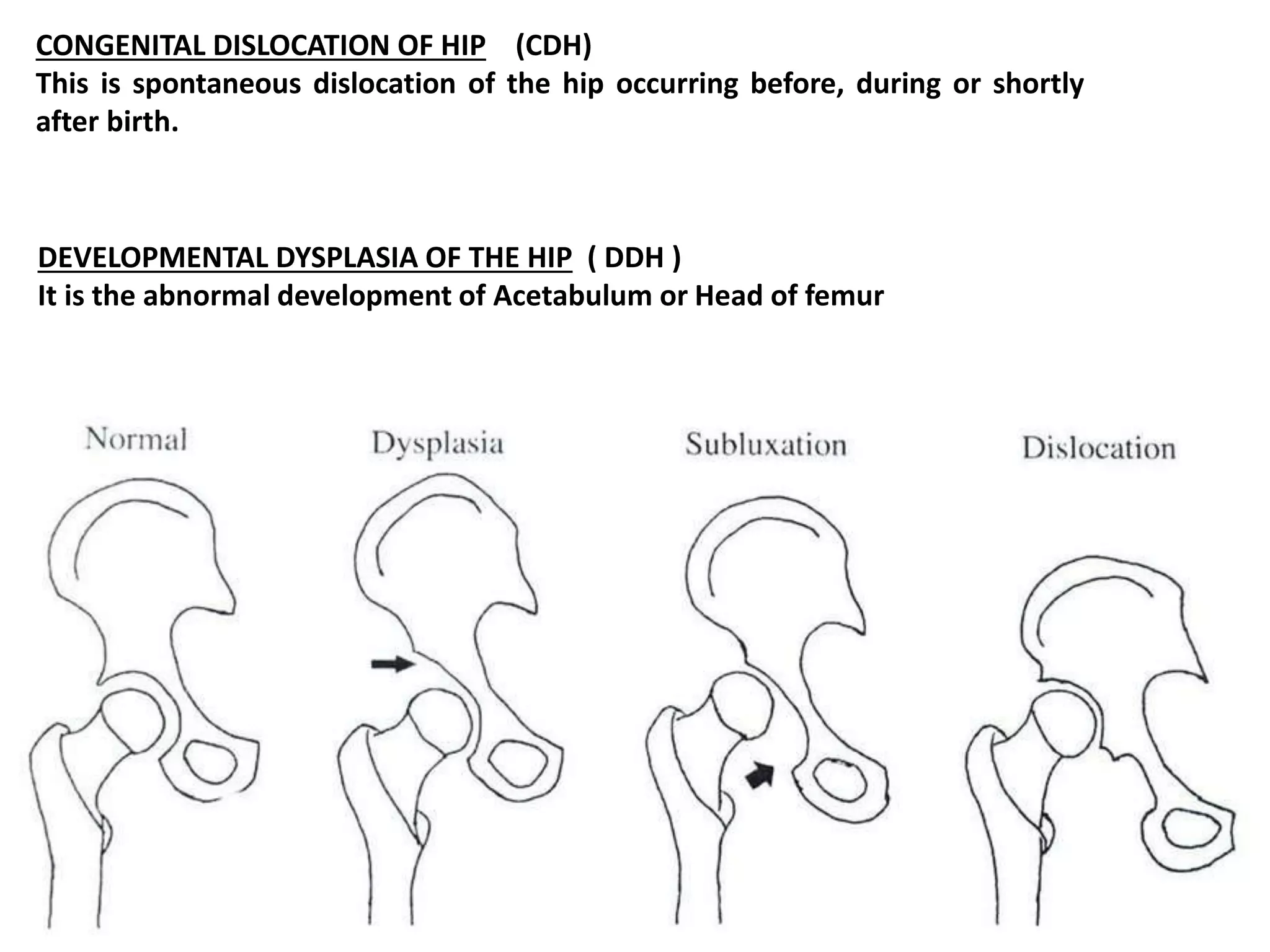 CDH AND DDH | PPTX | Pregnancy | Reproductive Health