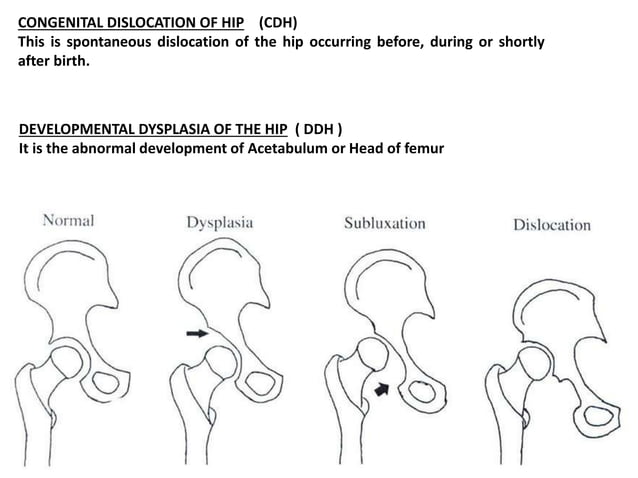 CDH AND DDH | PPTX | Pregnancy | Reproductive Health