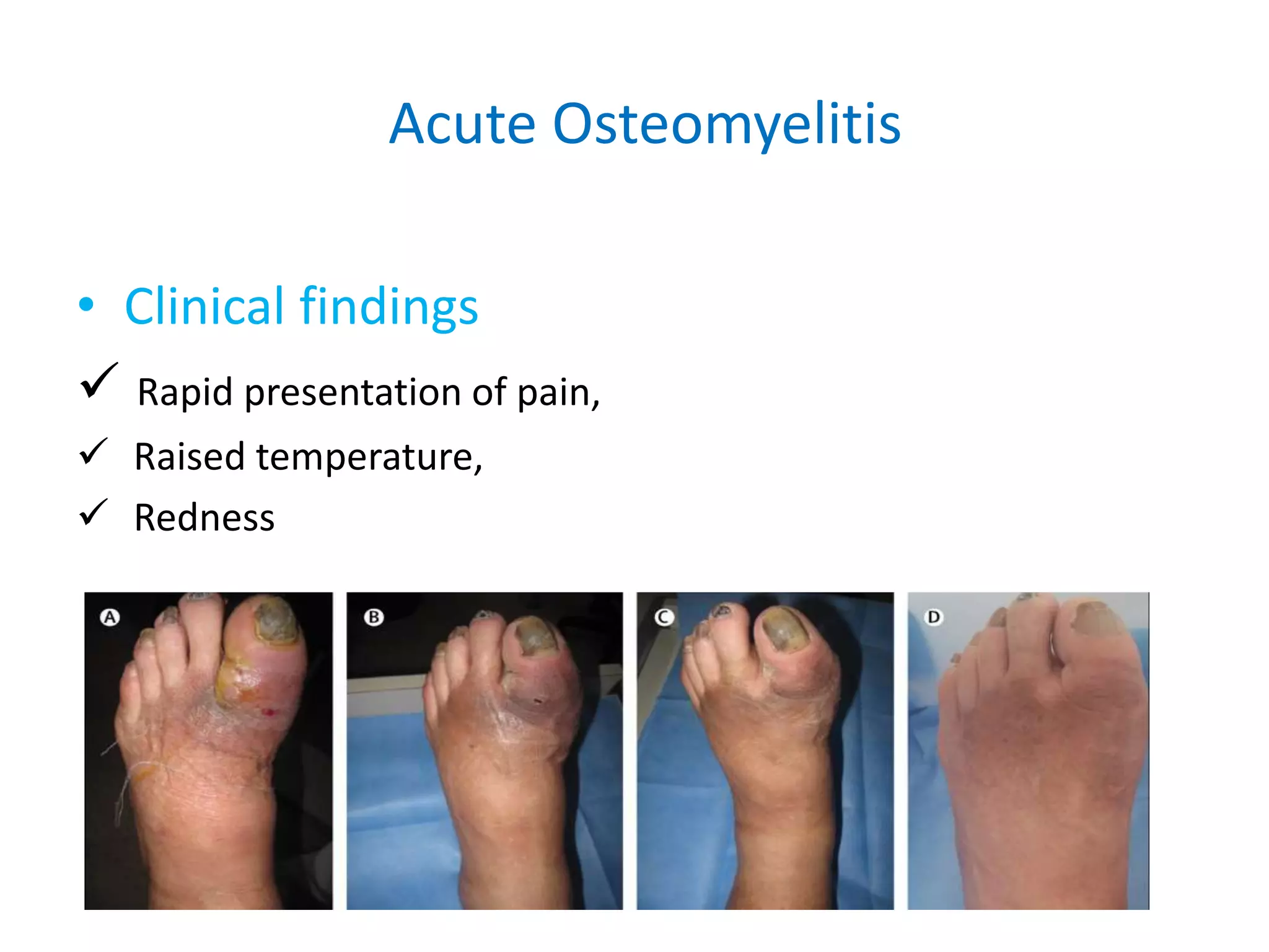 Acute and sub-acute Osteomyelitis | PPTX