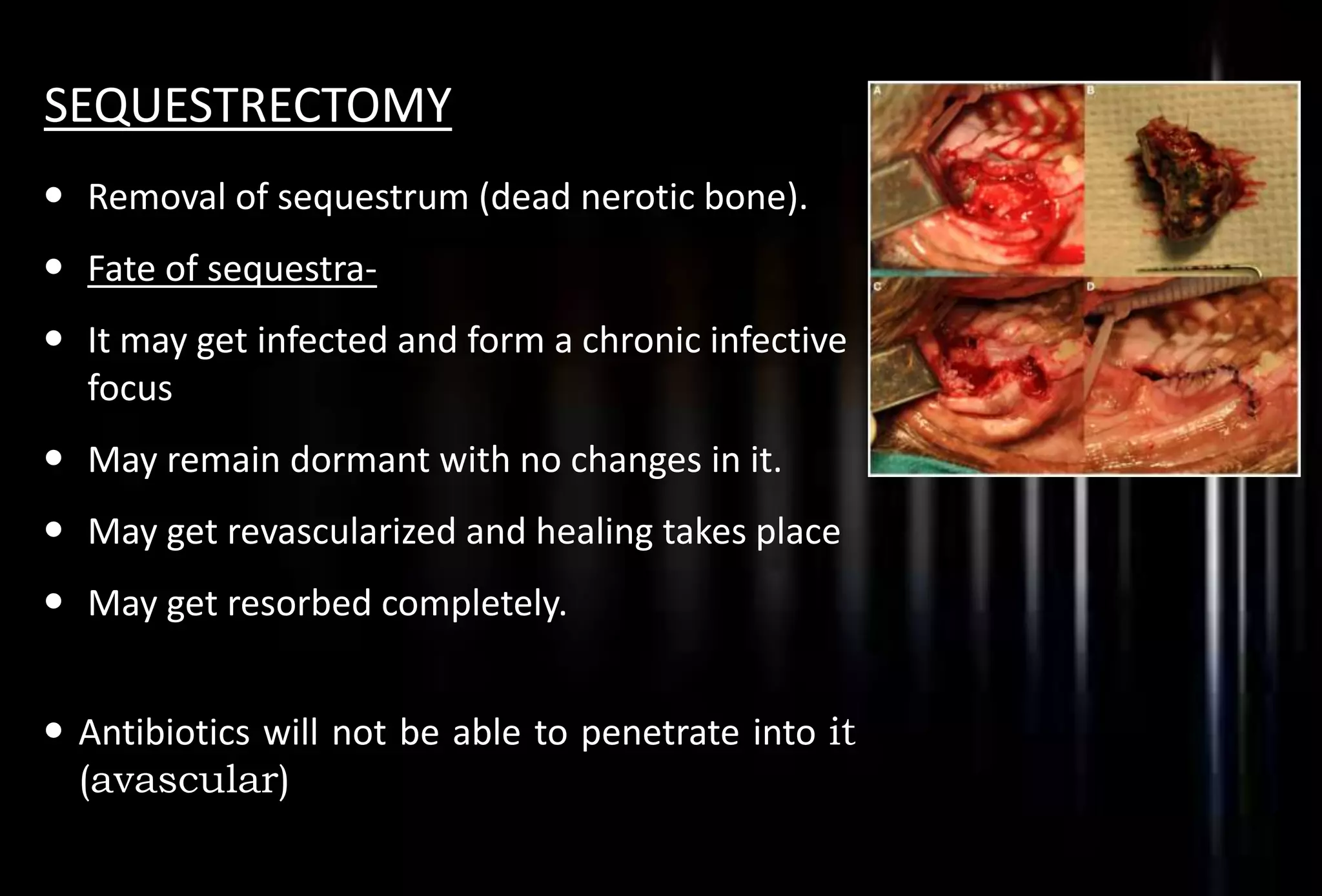 Osteomyelitis and osteoradionecrosis of jaws | PPTX