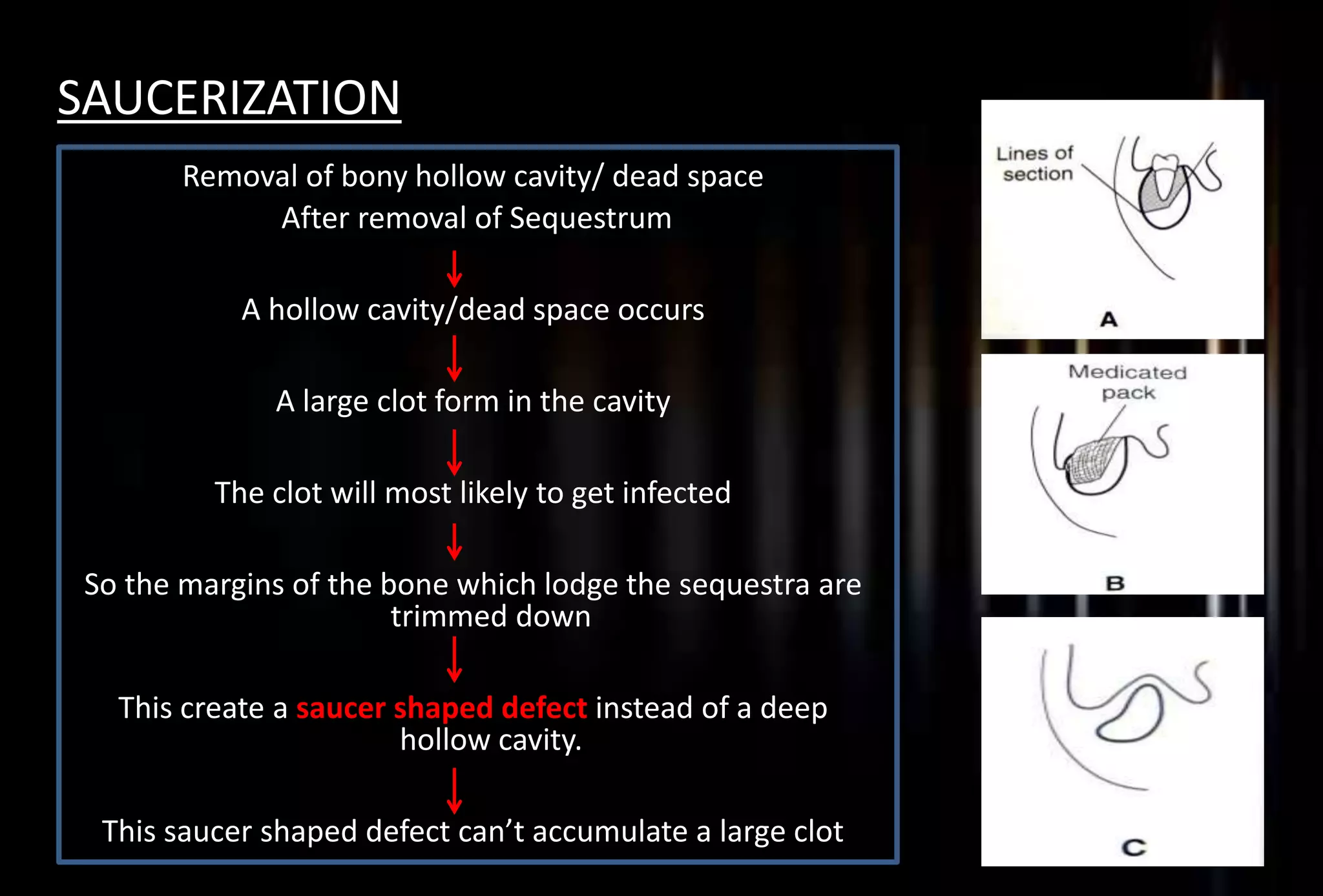 Osteomyelitis and osteoradionecrosis of jaws | PPTX