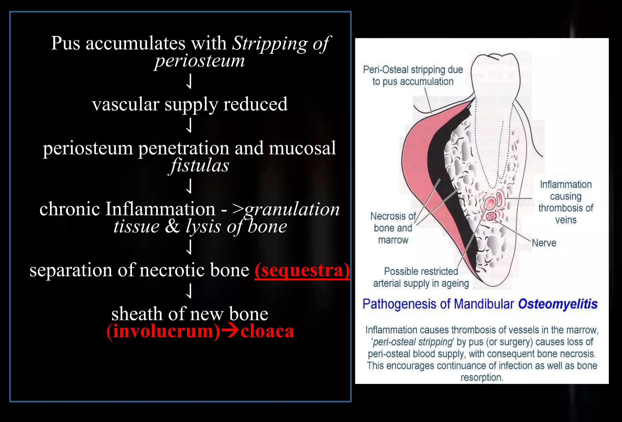 Osteomyelitis and osteoradionecrosis of jaws | PPTX