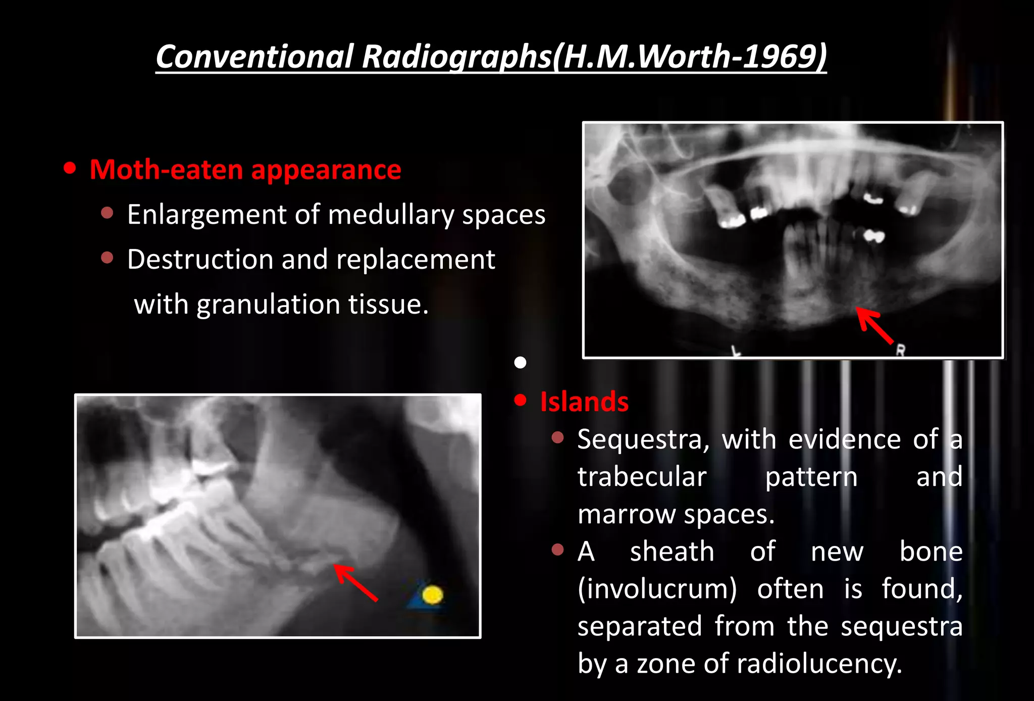 Osteomyelitis OF JAWS | PPTX