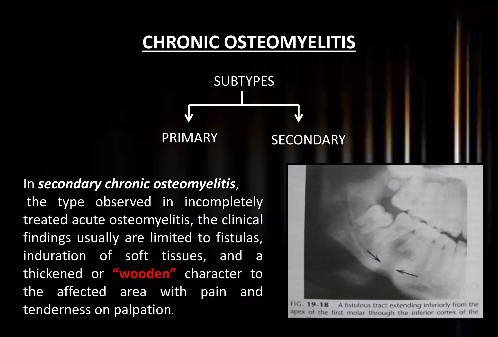 Osteomyelitis OF JAWS | PPTX