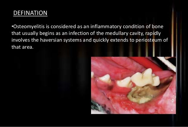 Osteomyelitis OF JAWS
