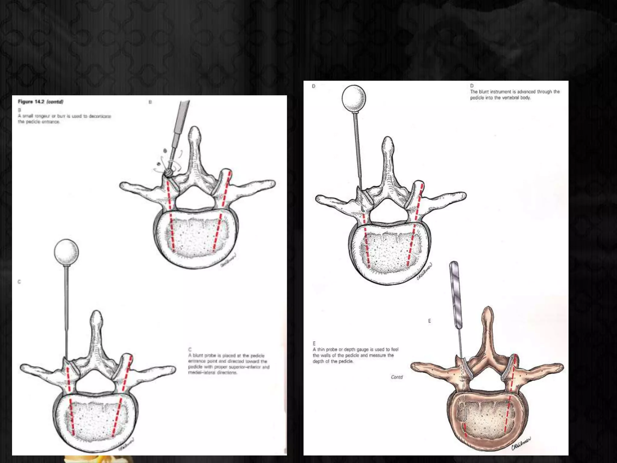 Posterior Spine Fixation | PPTX