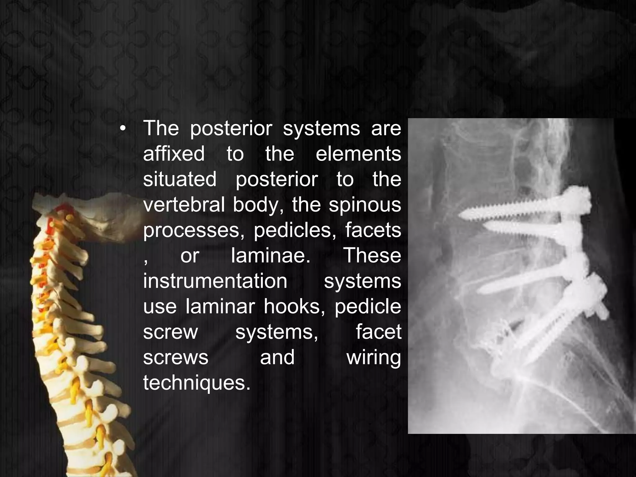 Posterior Spine Fixation | PPTX