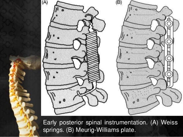 Posterior Spine Fixation