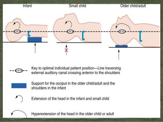 PAEDIATRIC AIRWAY