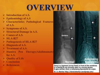 Ankylosing Spondylitis | PPTX