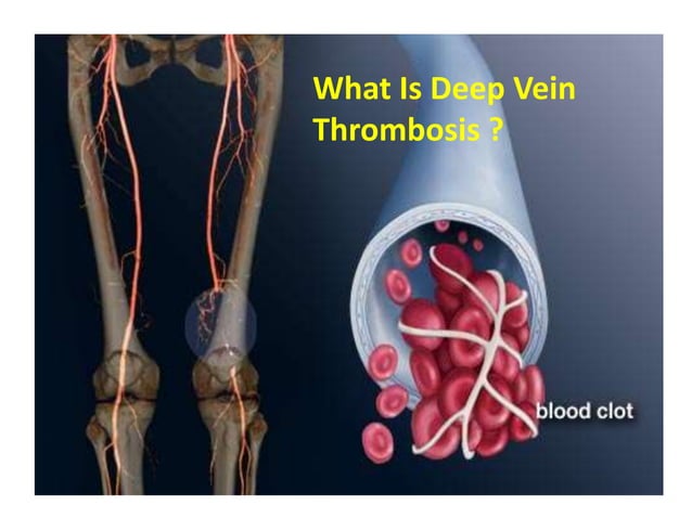 DVT PROPHYLAXIS IN ORTHOPEDIC SURGERIES | PPTX | Blood Disorders ...