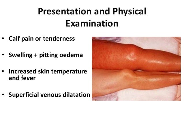 DVT PROPHYLAXIS IN ORTHOPEDIC SURGERIES