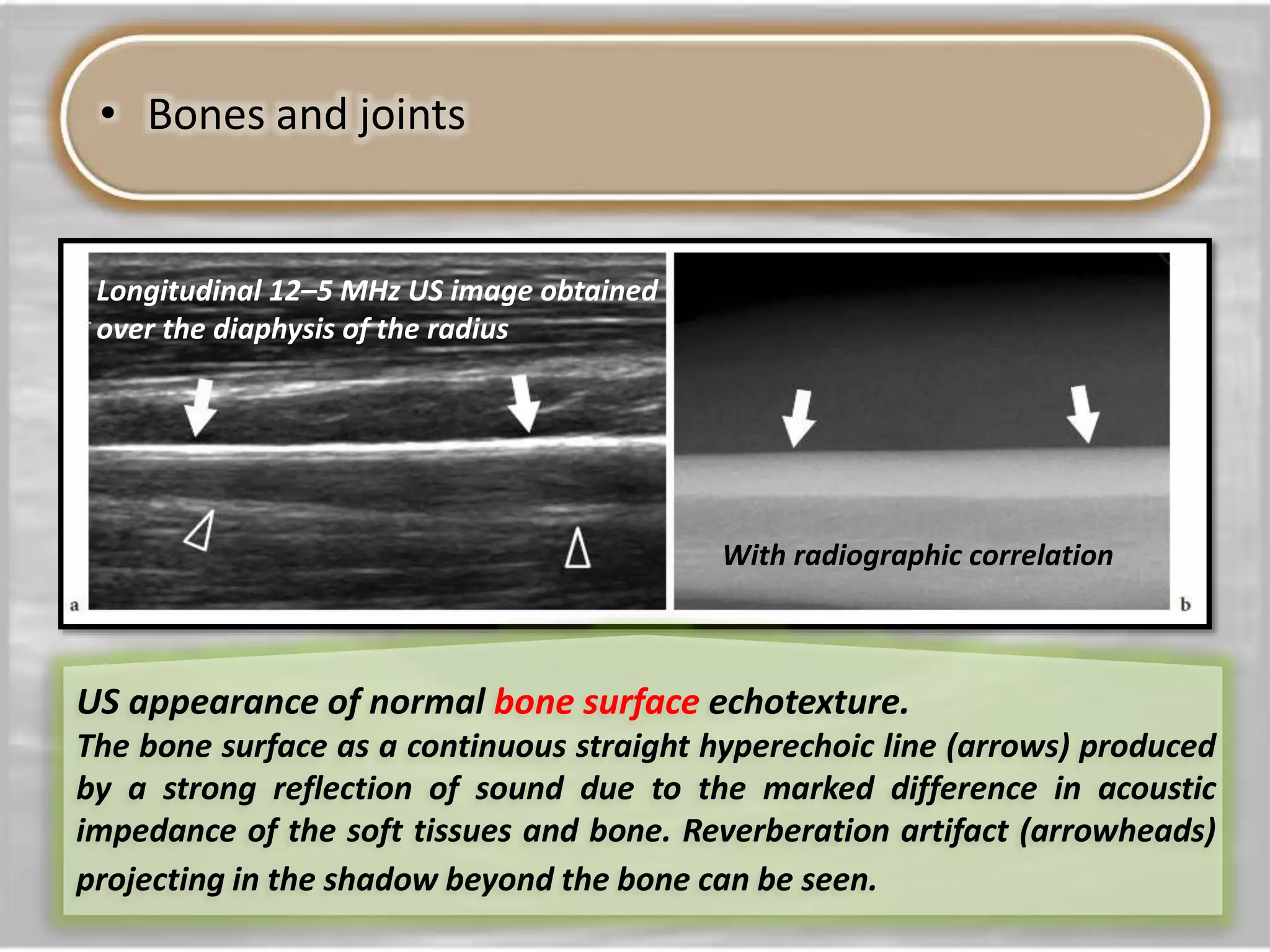 Role of ultrasound and color Doppler in evaluation of musculoskeletal ...