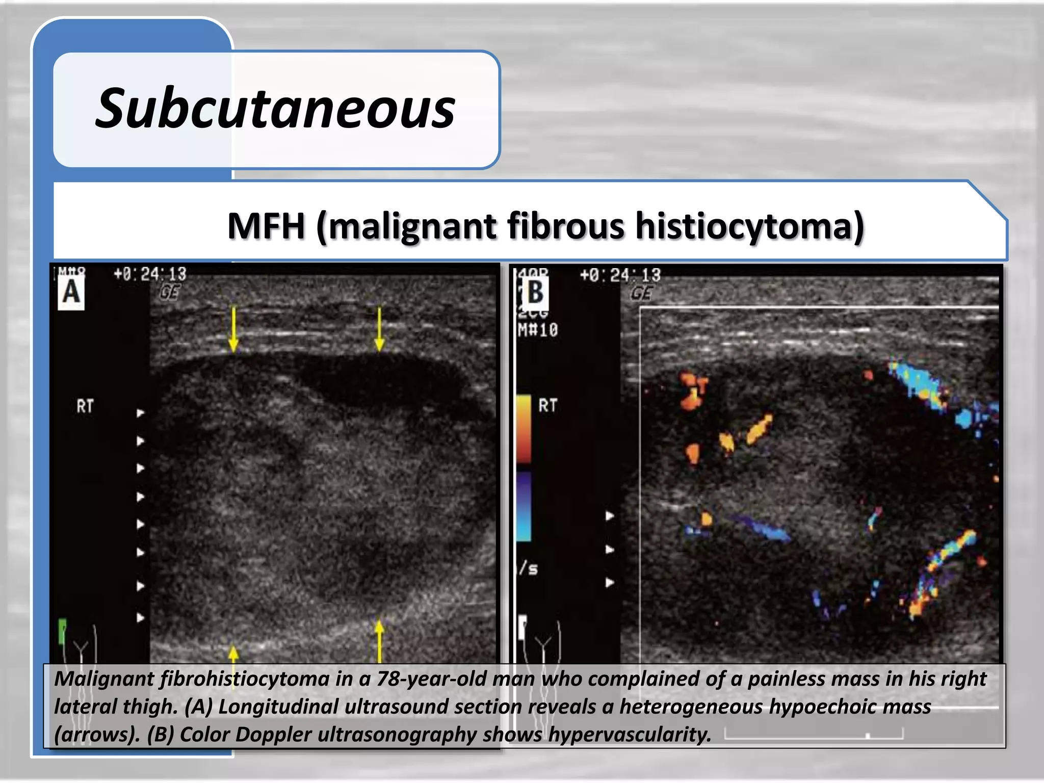 Role of ultrasound and color Doppler in evaluation of musculoskeletal ...
