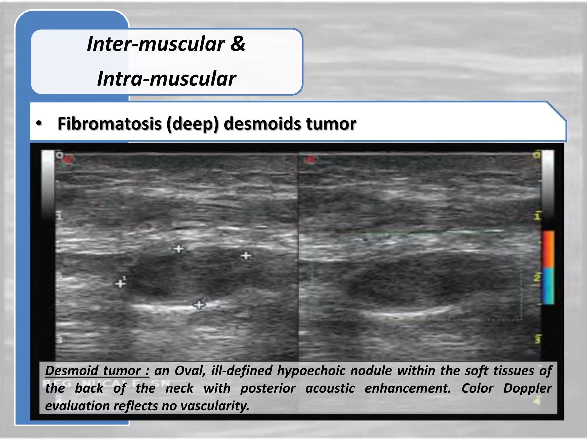 Role of ultrasound and color Doppler in evaluation of musculoskeletal ...