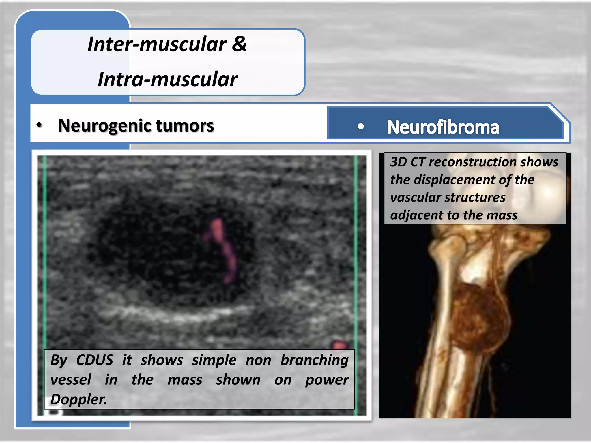 Role of ultrasound and color Doppler in evaluation of musculoskeletal ...