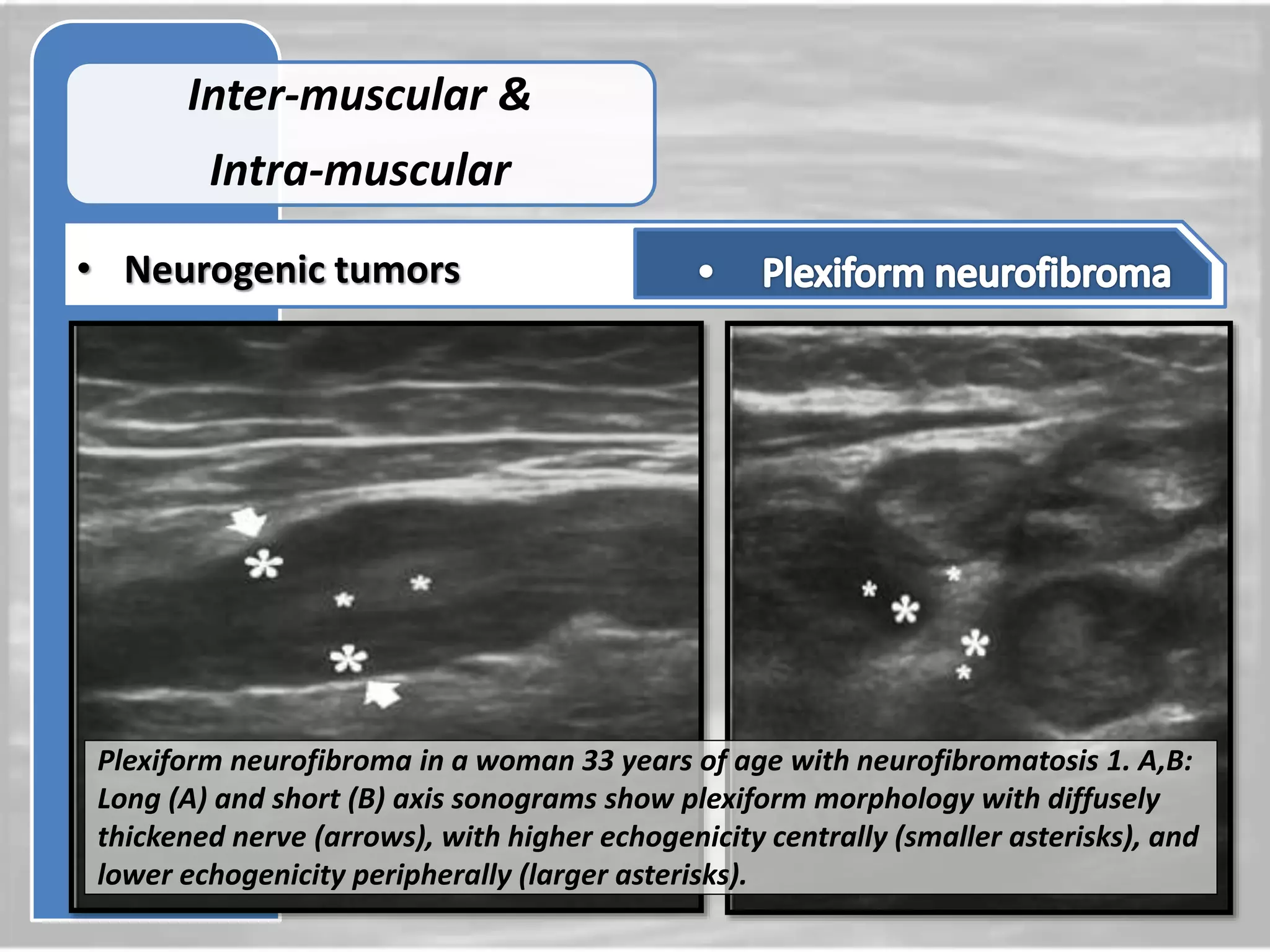 Role of ultrasound and color Doppler in evaluation of musculoskeletal ...