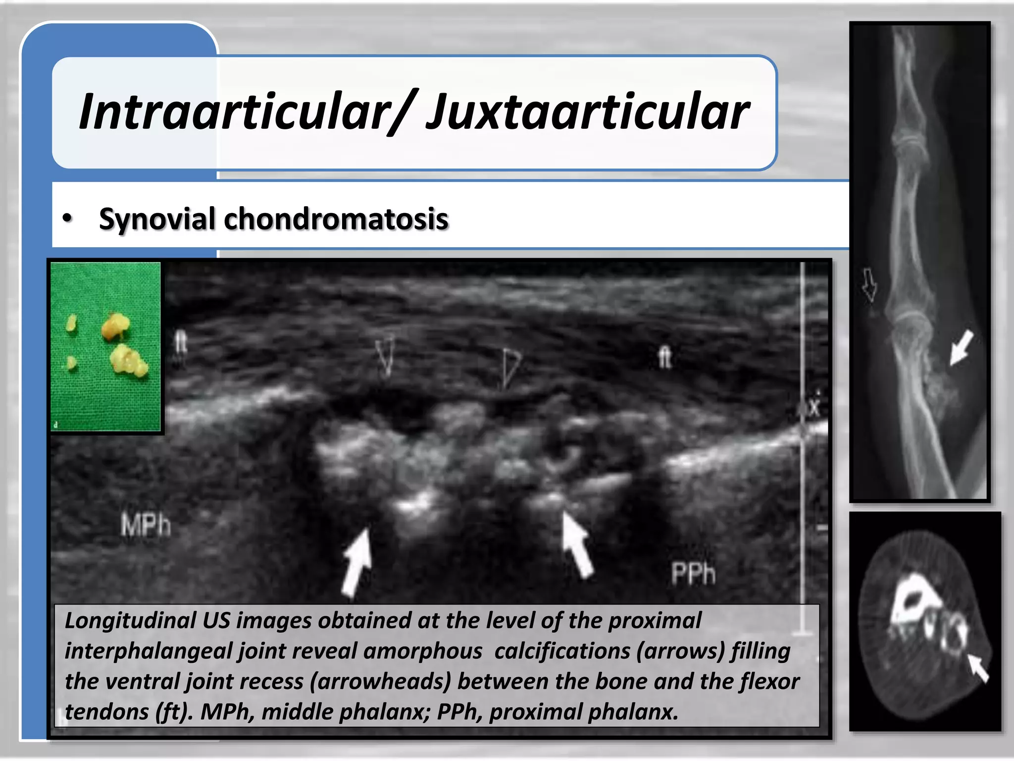 Role of ultrasound and color Doppler in evaluation of musculoskeletal ...