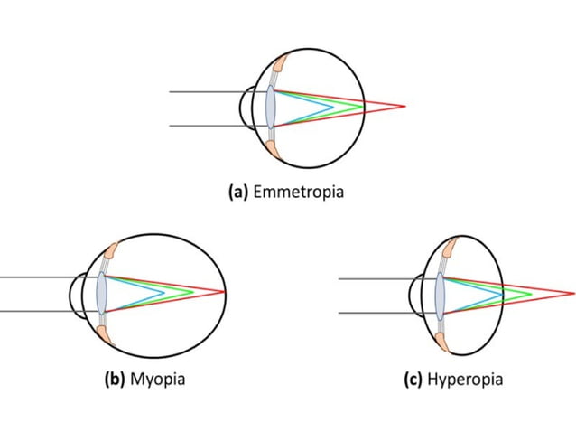 Subjective Refraction in details with each steps | PPTX