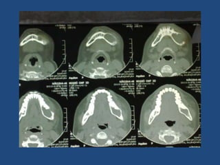 Case presentation of Gorlin Goltz syndrome | PPTX