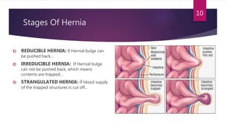 Hernia And Its Types Pptx