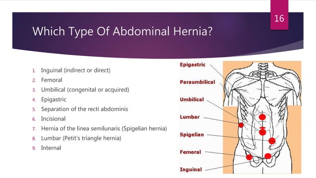 HERNIA and its types | PPTX | Digestive Disorders | Diseases and Conditions