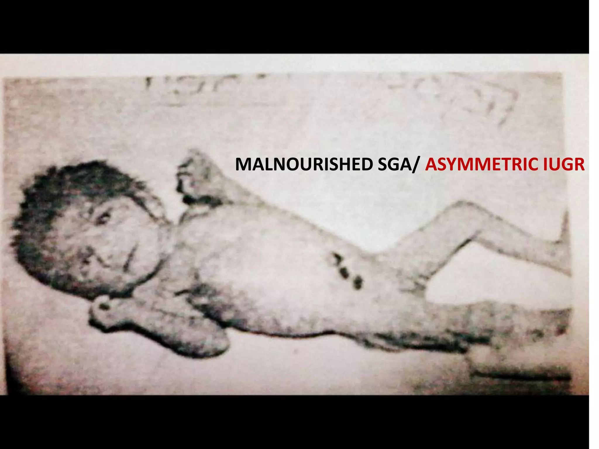 SMALL FOR GESTATIONAL AGE,LARGE FOR GESTATIONAL AGE -SSJ, CALICUT ...